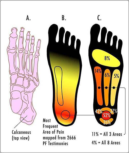足底筋膜炎plantar Fasciitis 博昌復健 ― 增生療法與運動傷害治療中心 Bo Chung Prolotherapy And Rehabilitation Clinic