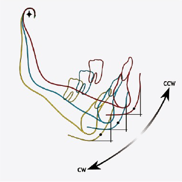 戴牙套為什麼可以改變臉型－林榆芩 醫師｜痞客邦