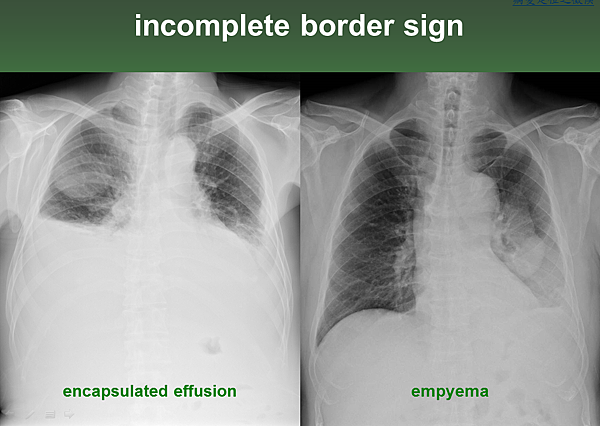 CXR sign 收錄－醫學筆記匯整 ED Notes｜痞客邦