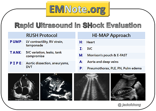 RUSH protocol for shock－醫學筆記匯整 ED Notes｜痞客邦