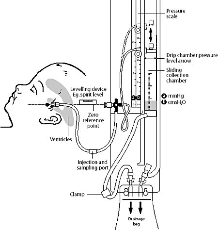 [神經外科]External Ventricular Drainage