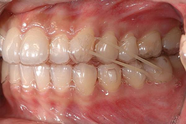 隱適美®數位隱形矯正 Invisalign®G3 台灣登場 インビザライン®G3 デビュー Invisalign®G3 Debut－蔡士棹醫師 ...