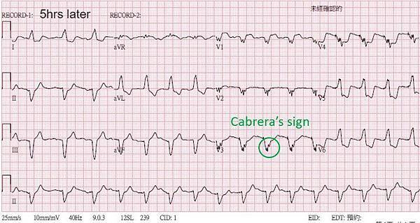 LBBB和急性心肌梗塞(Cabrera and Sgarbossa) @ ~Teachingcenter的醫學筆記~ :: 痞客邦