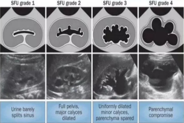 水腎的分級 Grading of Hydronephrosis－~Teachingcenter的醫學筆記~｜痞客邦